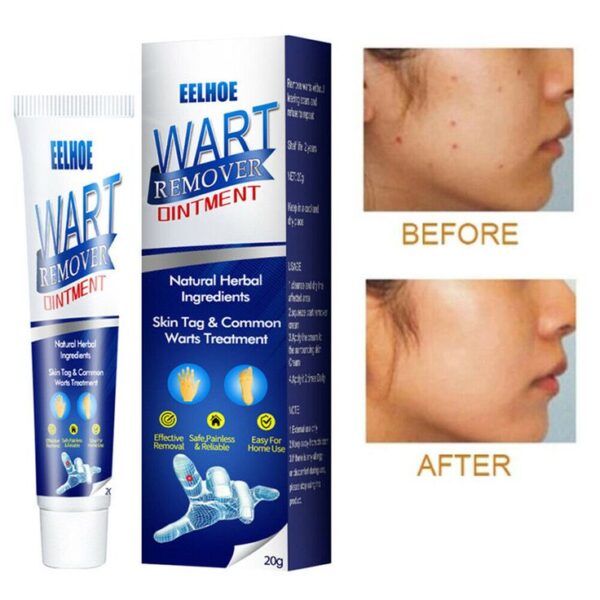 wart remover